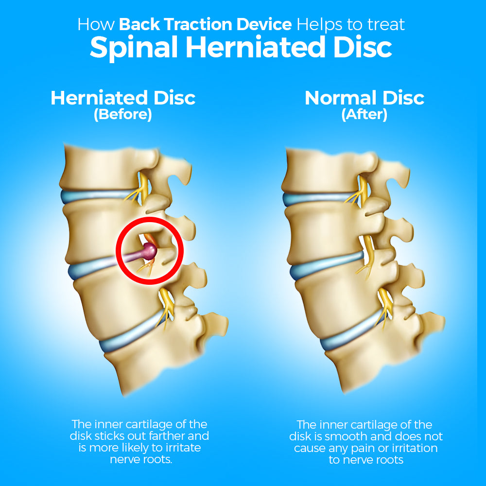 Back Traction Device - At-Home Back Pain Relief | Fisher Traction